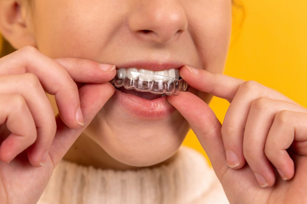 How Invisalign Can Help with Overbite, Underbite and Crossbite: A ...