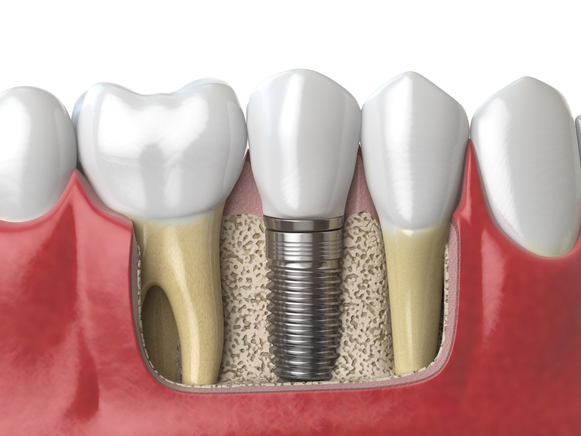What Are Dental Splints? An Overview – First Impressions Dental